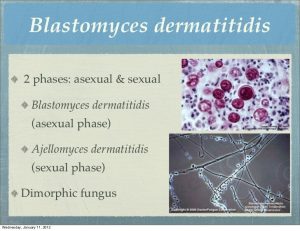 Blastomyces Dermatitidis (Blastomycosis) - Fungal Infections ...