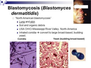 Blastomyces Dermatitidis (Blastomycosis) - Fungal Infections ...