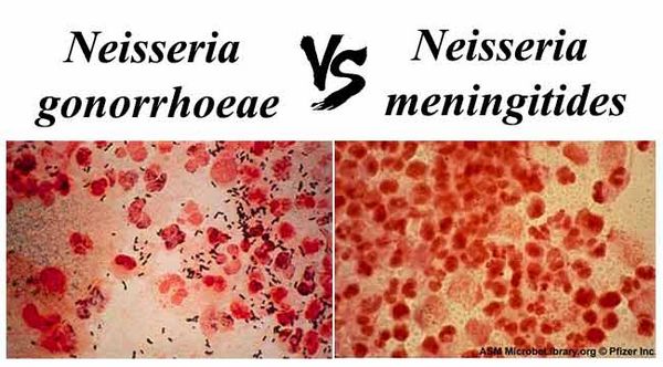 Neisseria Gonorrhoeae & Neisseria Meningitidis - Bacterial Infections ... Neisseria Gonorrhoeae & Neisseria Meningitidis - Bacterial Infections ...