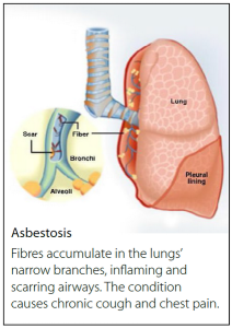 Asbestosis - Pneumonia - AntiinfectiveMeds.com