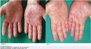 Management of Tinea Manuum - Fungal Infections - AntiinfectiveMeds.com