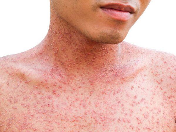 Measles - Viral Infections - AntiinfectiveMeds.com